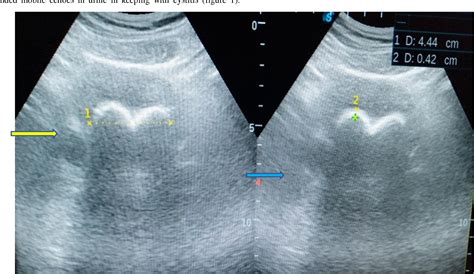 Figure 1 From Urinary Bladder Calculus In An Adult Male Patient