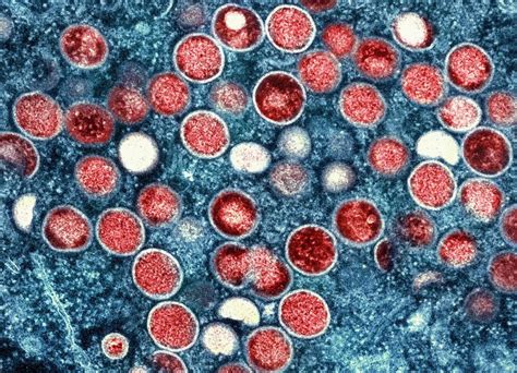 A Californian With Monkeypox Died Second Possible Us Death From Virus