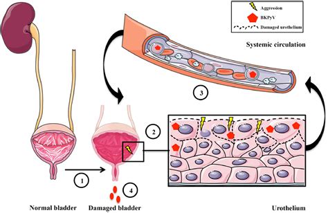 Bk Virus Infection In Allogeneic Hematopoietic Cell Transplantation An