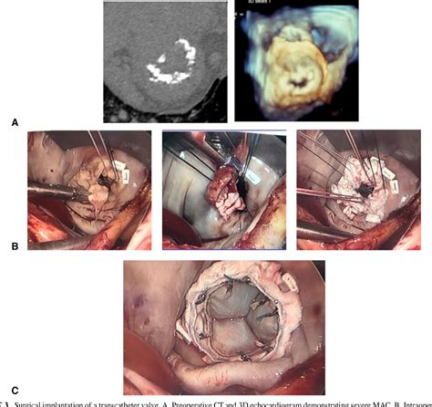 Figure 1 From Current Techniques For Severe Mitral Annular Calcification Semantic Scholar