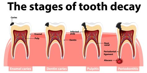 Classification Of Dental Caries Monolog Kehidupan