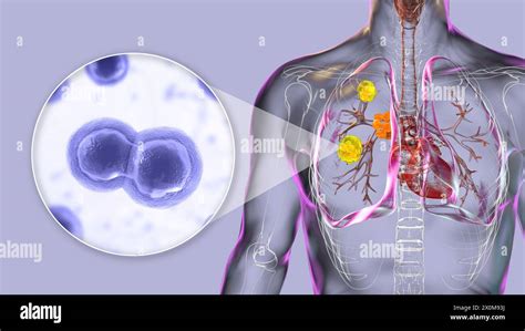 3d Illustration Of Pulmonary Blastomycosis And A Close Up Of The