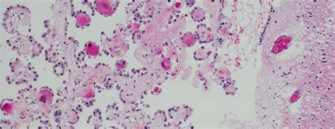 Faq Choroid Plexus Cysts Patient Education Ucsf Health