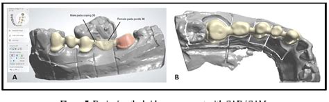Figure 5 From The Modification Of Split Pontic As Non Rigid Connector