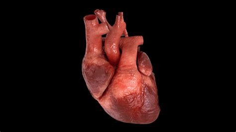 3d Model Of Left Ventricle Outflow Tract Obstruction Voka