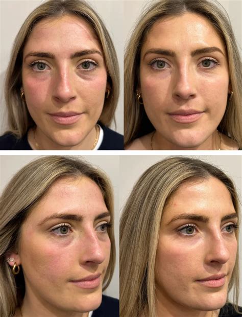 Facial Aesthetics Before And After Dr Andrew Culbard
