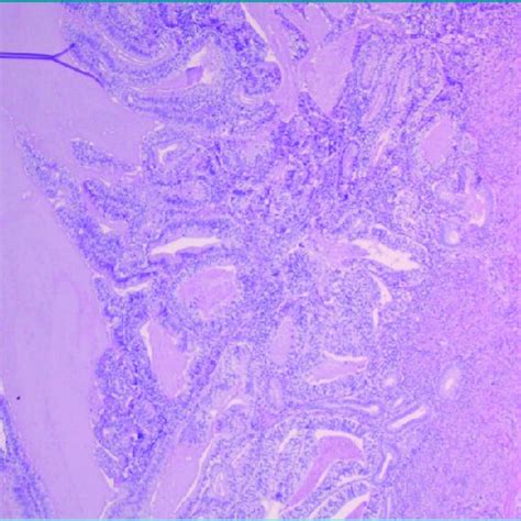 He X 5 Endometrial Endometrioid Carcinoma Endometrial Cavity