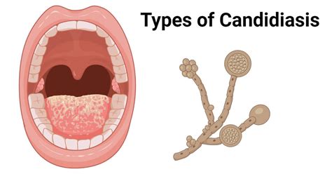 Candida Albicans Classification Iogk