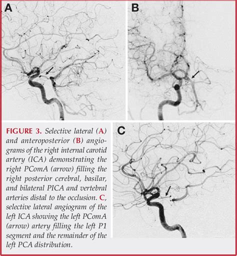 Figure 3 From Occipital Artery‐to‐posterior Inferior Cerebellar Artery Bypass For Treatment Of