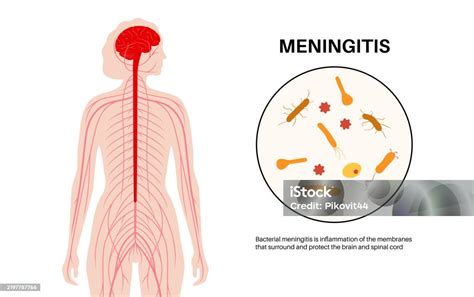 Meningitis Medical Poster Stock Illustration Download Image Now
