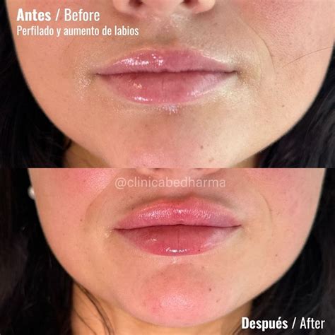 Aumento De Labios En Medellín Clínica Estética En Medellín