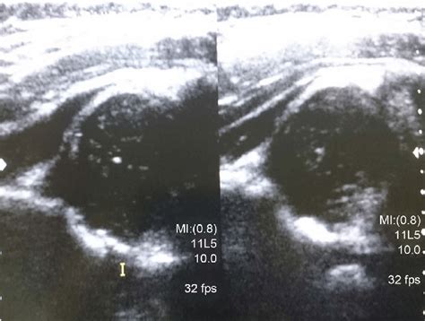 Dysplastic Hip Joint Shows Shallow Acetabulum Lack Of Femoral Head