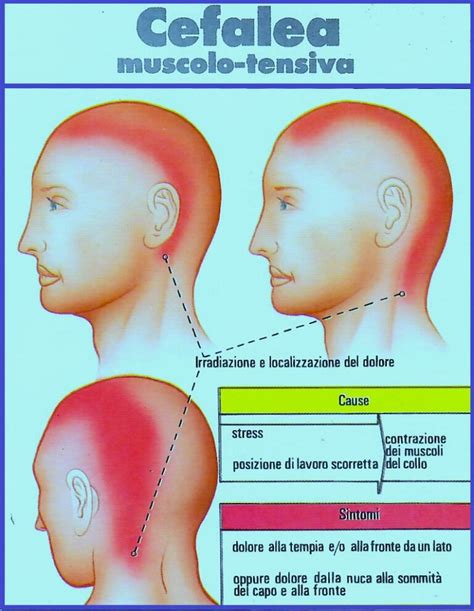 Cefalea Muscolo Tensiva Blog Di Pociopocio