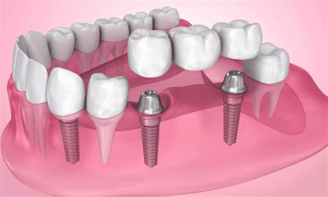 Dental Code D6740 When And Why You Need A Full Crown Lema