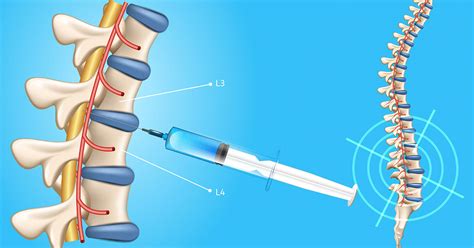 Lumbar Puncture Seattle Wa Brain And Spine Surgery
