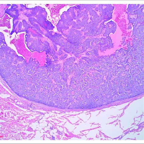 Solid Papillary Carcinoma Histopathology From Final Excisional Biopsy
