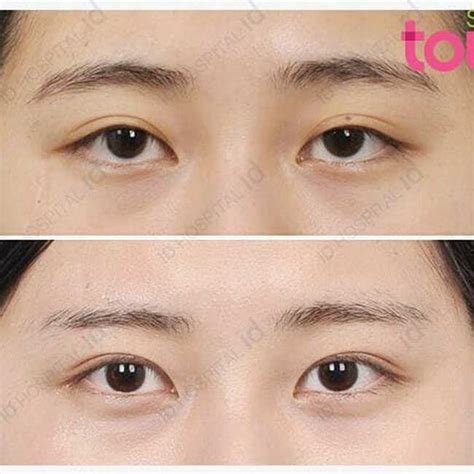When Can You Wear Makeup After Eyelid Surgery Saubhaya Makeup