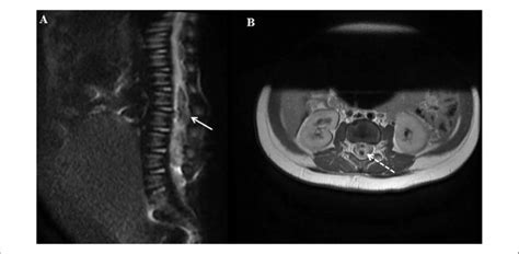 A Sagittal Diffusion Weighted Imaging Dwi Series Showed Diffusion Download Scientific