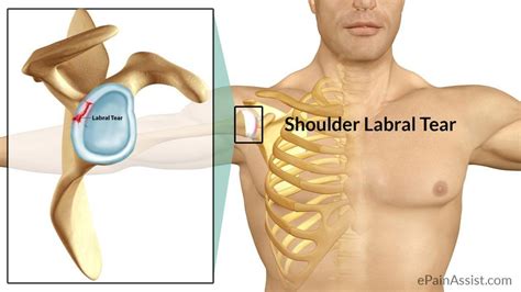 Shoulder Labrum Injuries Artofit
