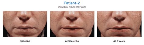 Bellafill Well Medical Arts West Seattles Medispa Offering Botox