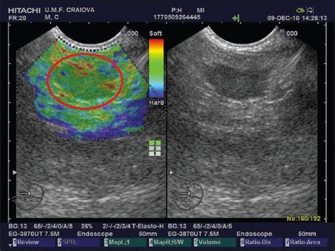 A Patient With A Benign Lymph Node The Elastography Image In The Left