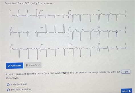 Solved In Which Quadrant Does This Persons Cardiac Axis