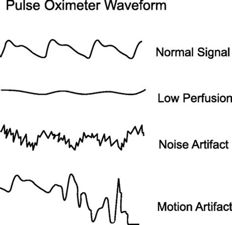 What Does Oximeter Reading Mean At Kelly Alexander Blog