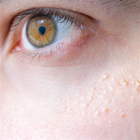 How To Get Rid Of Milia Tiny Bumps On Eyelids White Bump On Eyelid