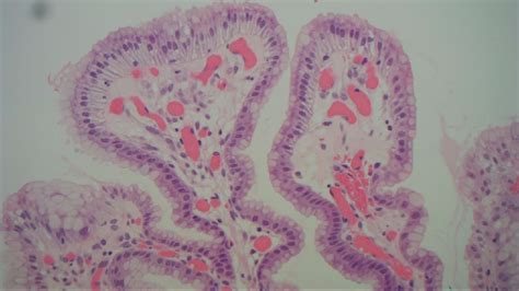Antral Gastric Hyperplastic Regenerative Inflammatory Polyp