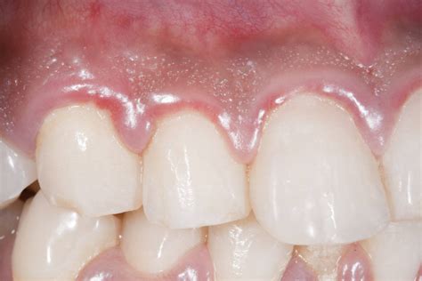 El Blog De Ceess Sufrir Periodontitis Se Asocia Con Mayor Riesgo De