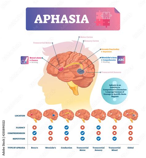 Aphasia Vector Illustration Labeled Educational Scheme With Brain Disorder Stock Vector Adobe