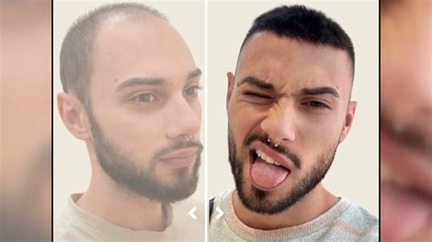 Daniel Defiende La Prótesis Capilar Para Evitar La Calvicie Voy Al Gimnasio Monto En Moto