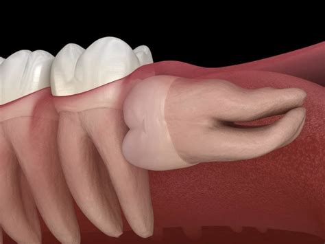 4 Types Of Wisdom Teeth Impactions Laurich Dentistry