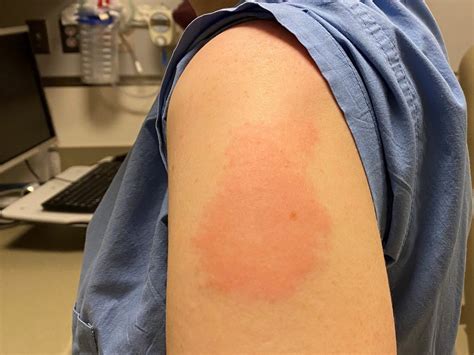 Vaccine Rash