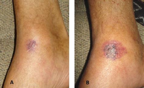 Vibrio Vulnificus Treatment Molecular Study Of Vibrio Vulnificus