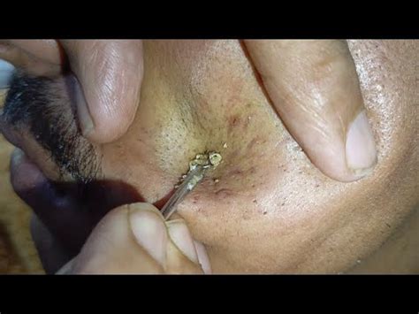 Sac Dep Spa Deep Blackheads Sac Dep Spa Pimple Popping New By Sac