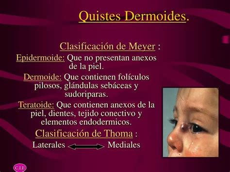 Ppt Quistes Dermoides Powerpoint Presentation Free Download Id