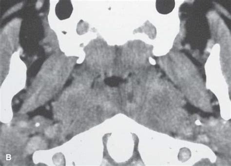 Benign Lymphoid And Other Reactive And Proliferative Processes