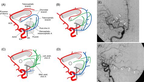Illustration Of Distal Annexation From Choroidal To Telencephalic