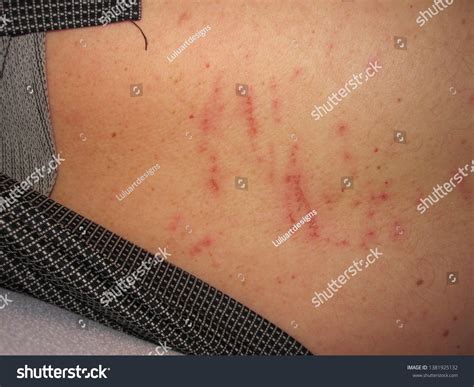 What Kind Of Rash Looks Like Scratches At Donna Champion Blog