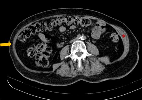 Abdominal Pseudohernia A Rare Complication Of Herpes Zoster Leading To