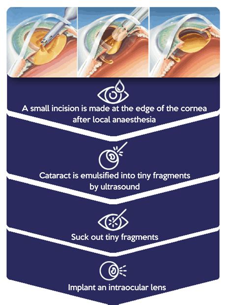 Understand The Causes Symptoms And Ultrasound Cataract Treatment