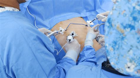 Gallbladder Surgery Cholecystectomy Op Dr Volkan Arayici