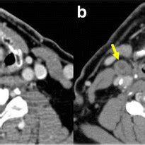 Pyriform Sinus Cancer