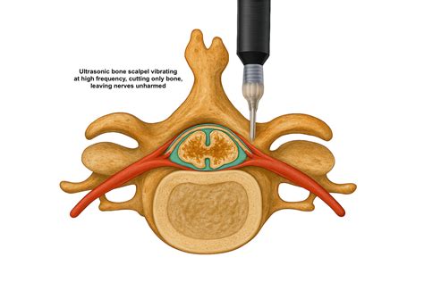 Minimally Invasive Lumbar Decompression Dr Yu Chao Lee
