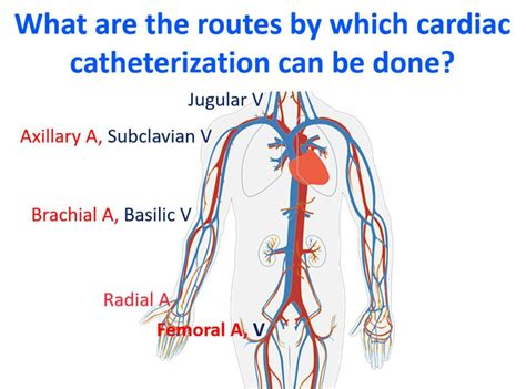 What Is A Left And Right Heart Catheterization At Oliver Lake Blog