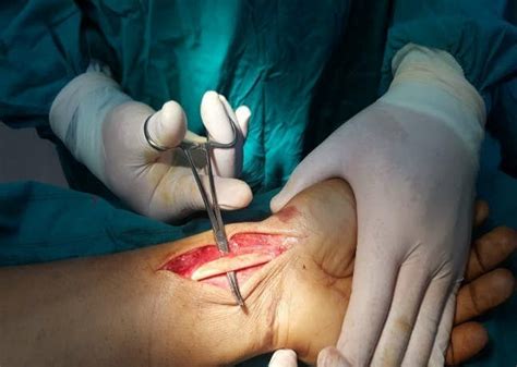 Flexor Carpi Radialis Tendon After Sheath Release Download Scientific