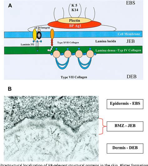 Figure 4 From Immunofluorescence Mapping For The Diagnosis Of Epidermolysis Bullosa Semantic