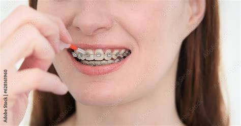 Close Up Woman Using Interdental Brushes With Teeth Braces Oral