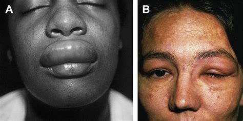Urticaria And Allergy Mediated Conditions Primary Care Clinics In